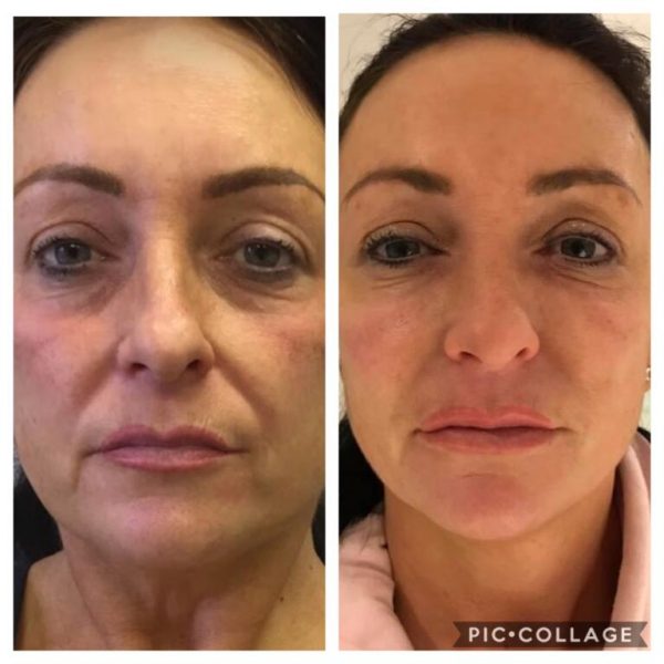 Ageing Cheeks | SG Aesthetics